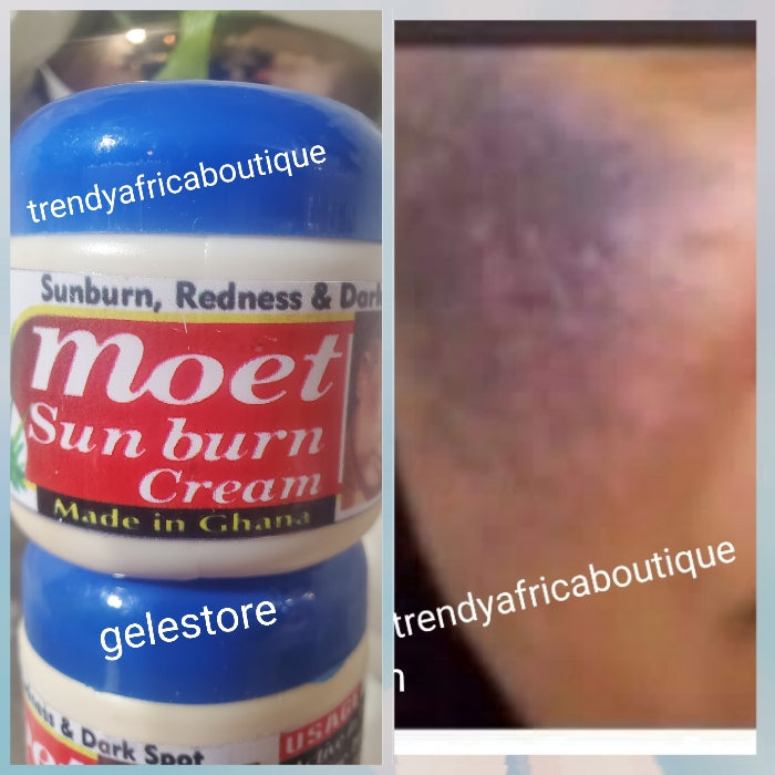 Another Bangar!!! Moet Sun Burn face Cream. Formulated with aloe vera ...